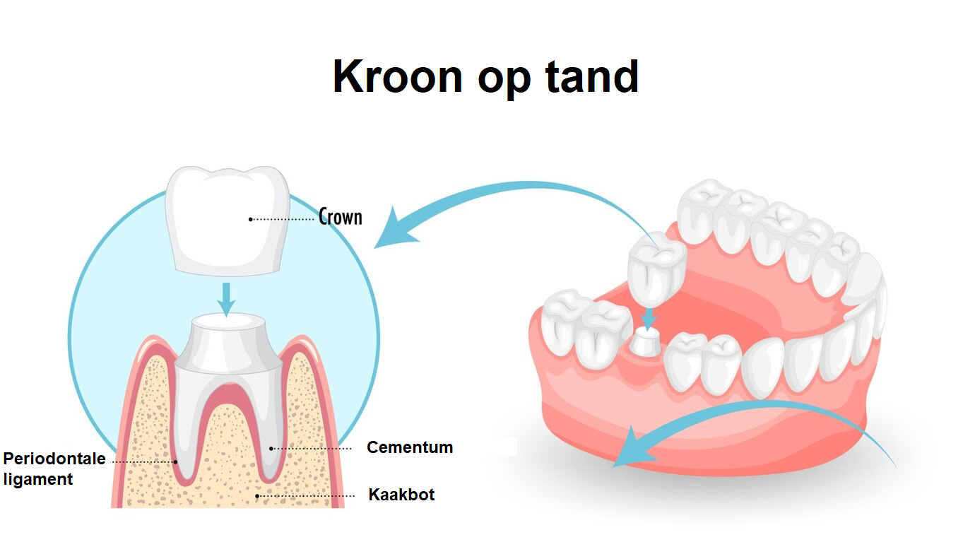 Kroon op tand - Tandartsenpraktijk Oranjebuurt Assen